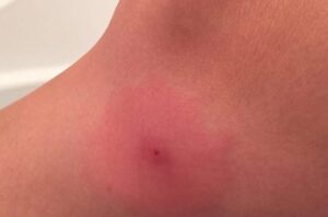 Redback Spider Bite: Identification, Symptoms, First Aid & Prevention ...